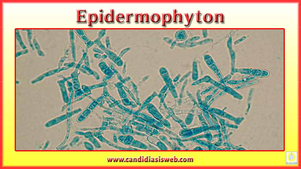 ¿Qué es? - Epidermophyton