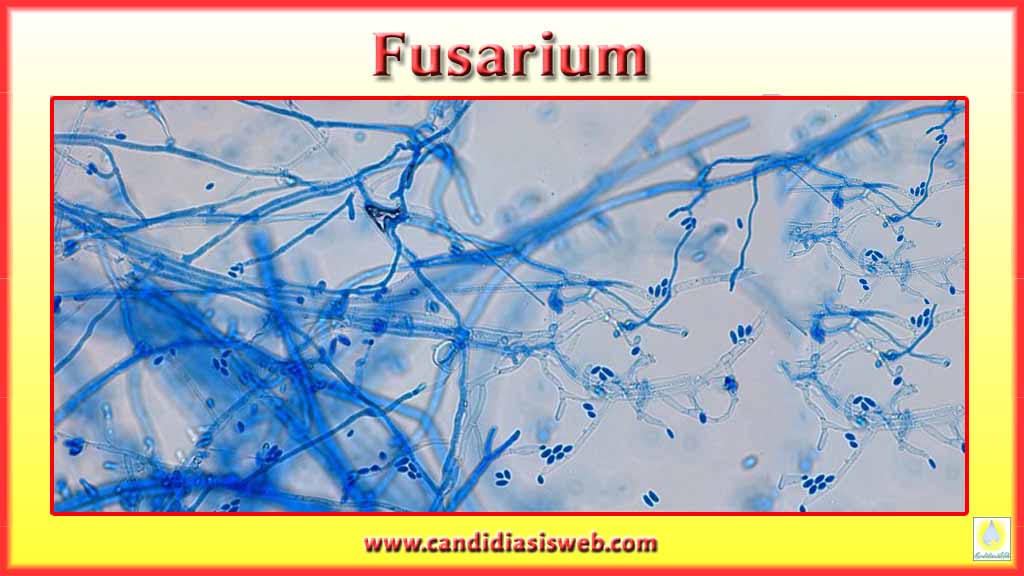 ¿Qué es? - Fusarium