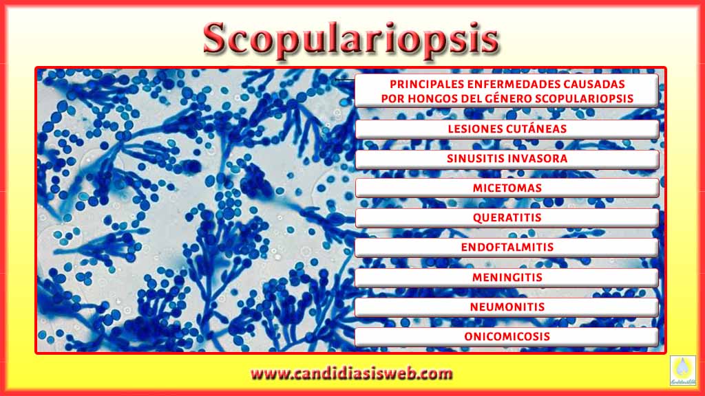 ¿Qué es? - Scopulariopsis