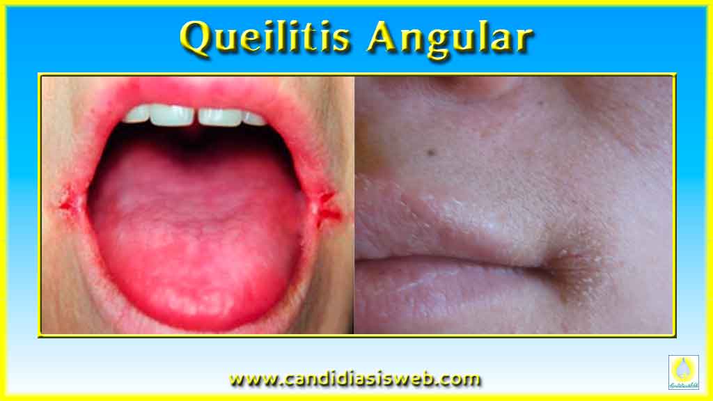 Candidiasis mucocutáneas - Queilitis angular