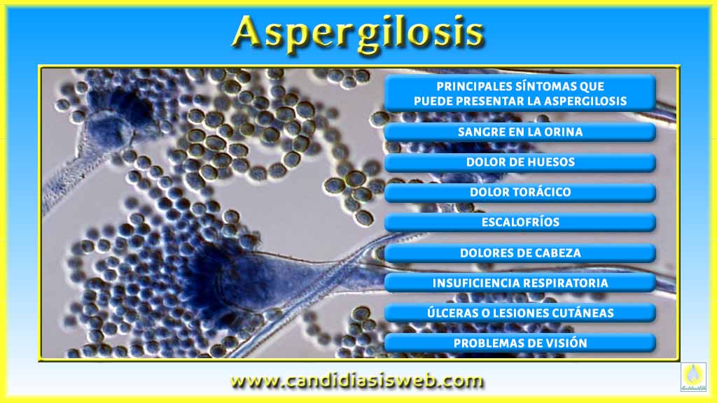 Enfermedades por hongos - Aspergilosis
